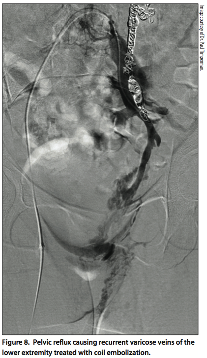Treatment of Recurrent Varicose Veins - Endovascular Today