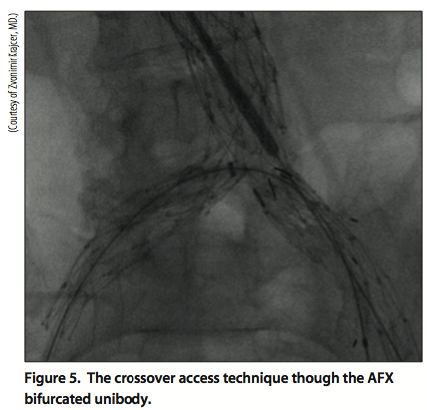 The Staying Power of Anatomical Fixation and ActiveSeal™ Endograft ...