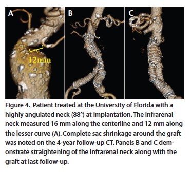 A New Angle on EVAR - Endovascular Today