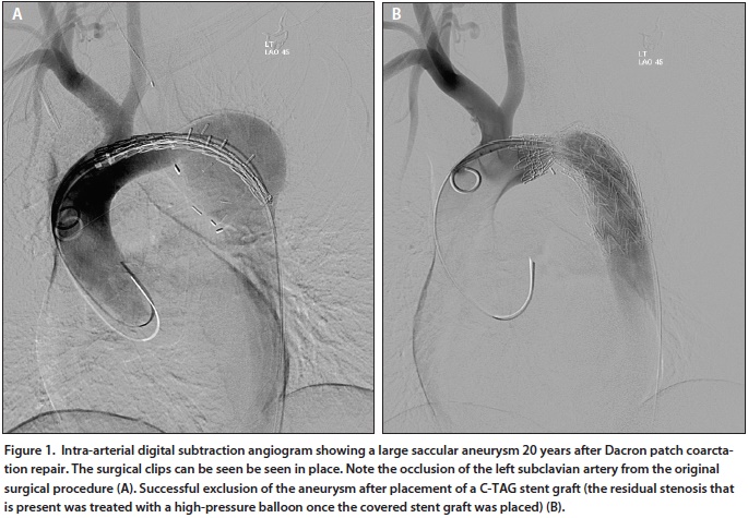 Aneurysmal Complications of Coarctation - Endovascular Today