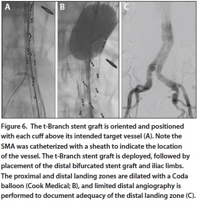 Endovascular Repair of TAAAs With the t-Branch Multibranched Stent ...