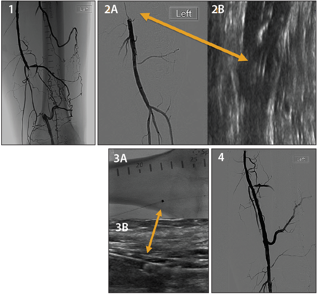 Laser Atherectomy