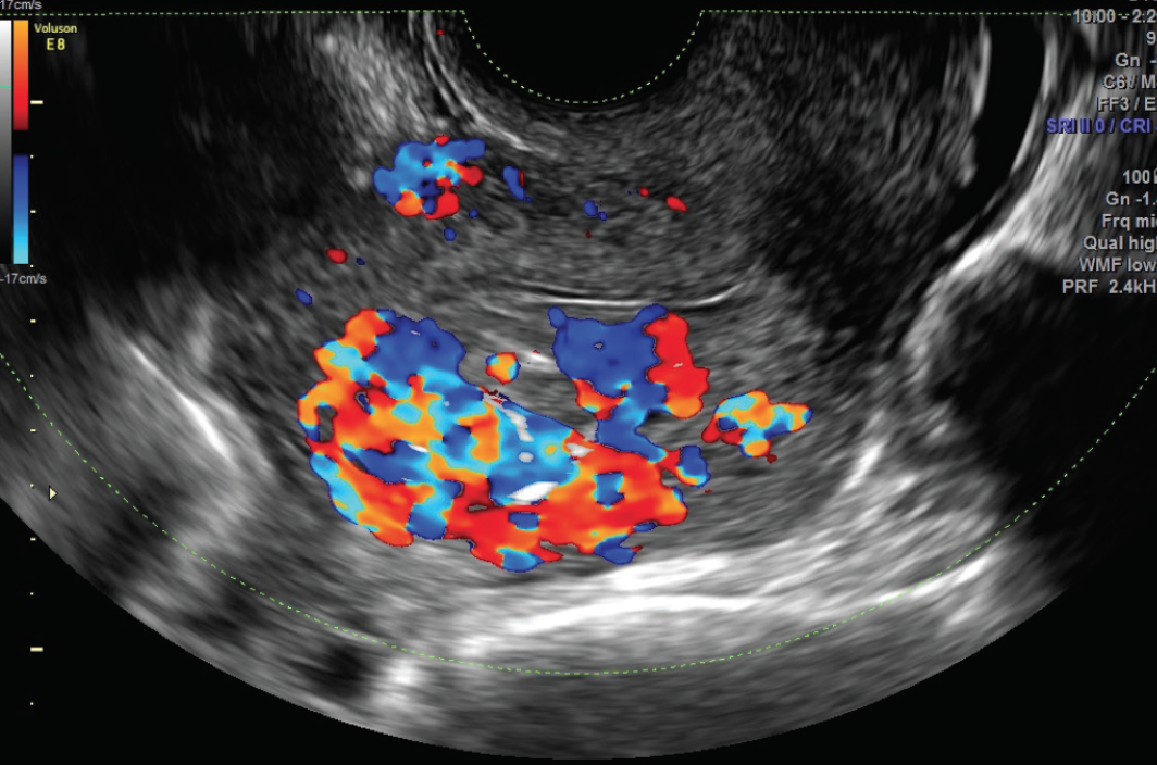 Endovascular Today Diagnosis And Treatment Of Uterine And Pelvic Endovascular Today Diagnosis And Treatment Of Uterine And Pelvic