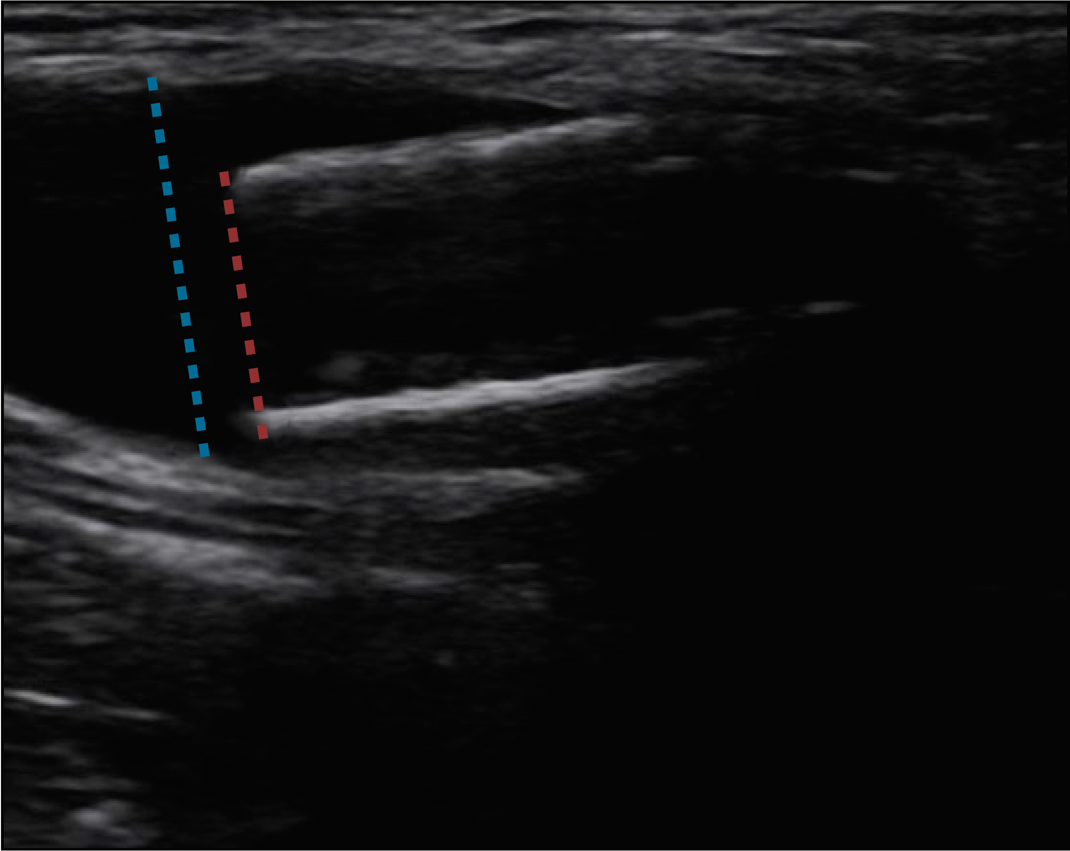 Undersizing to the Outflow Vein - Endovascular Today