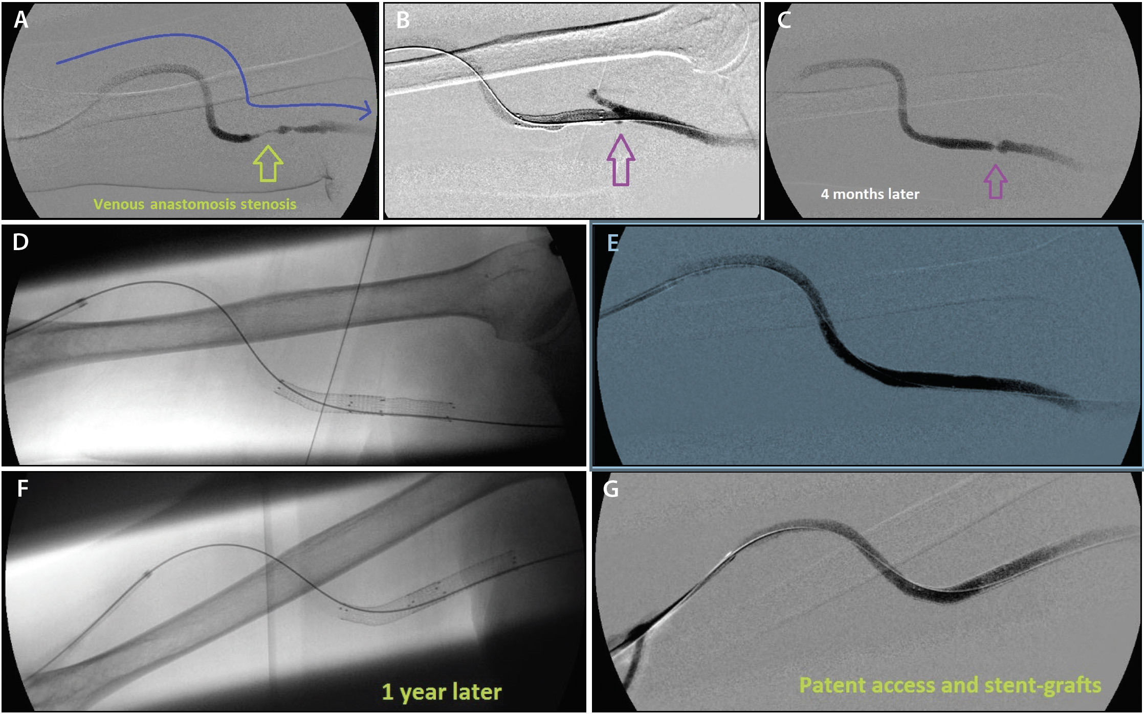Undersizing to the Outflow Vein - Endovascular Today