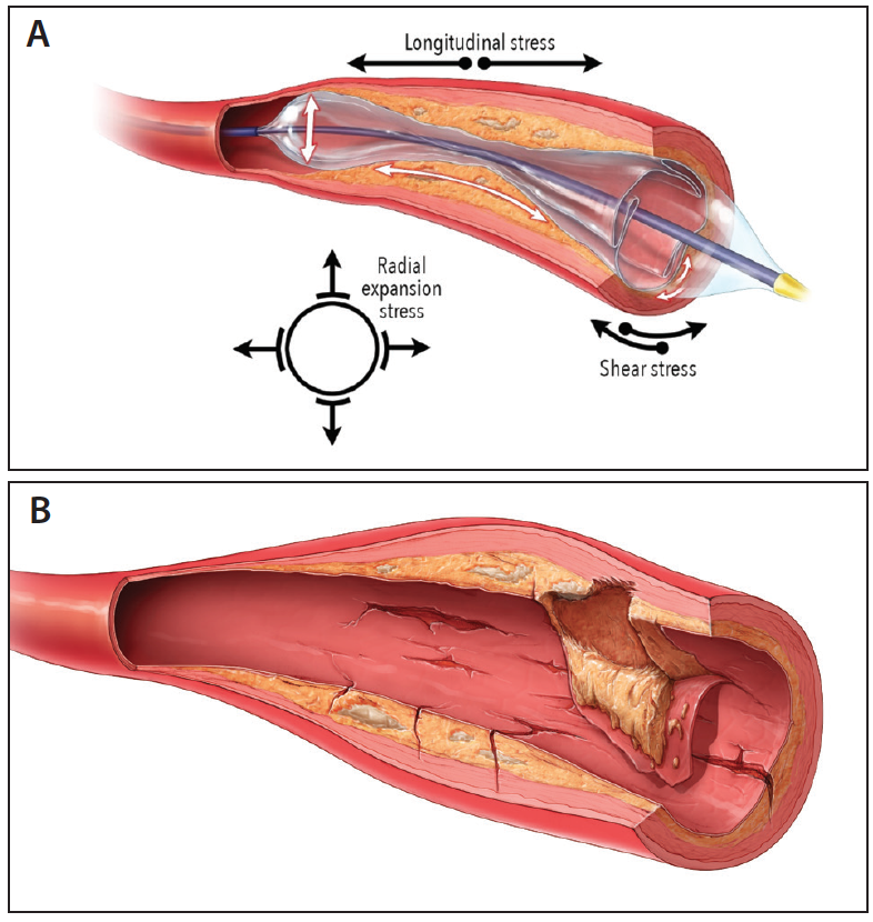 Endovascular Today Post PTA Dissection Clinical Impact Endovascular Today Post PTA Dissection Clinical Impact