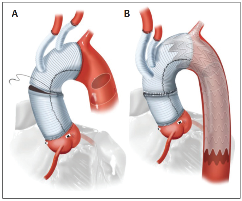 Endovascular Today Hybrid Techniques For Surgical Repair Of Acute