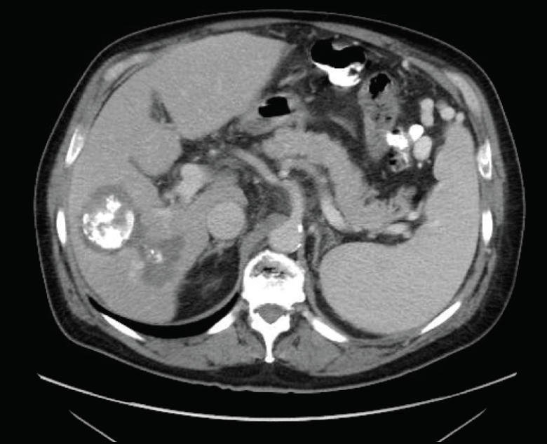 Case Report: Transarterial Embolization and Thermal Ablation for ...